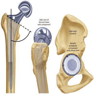 Totale Heup Prothese Protocol | Fysiotherapie4all