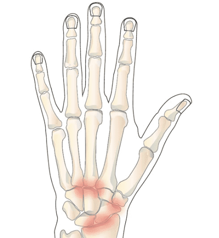 De Behandeling Van Het Polsgewricht | Fysiotherapie4all