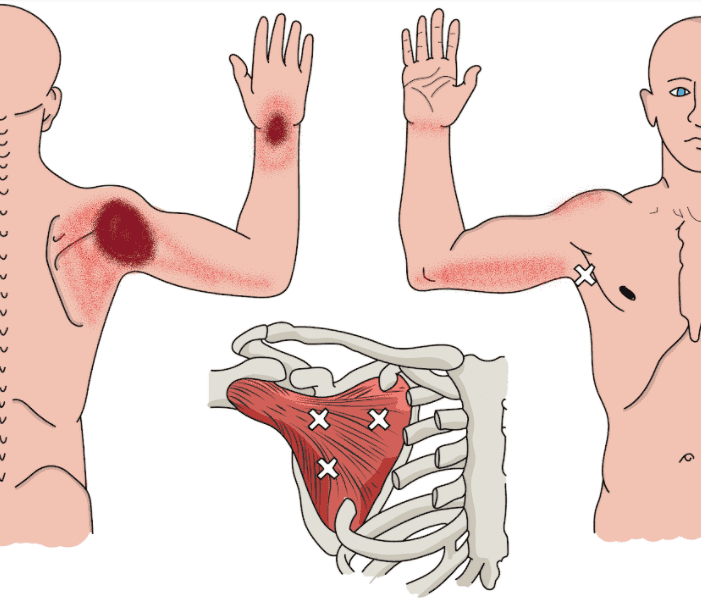 Verkalking In De Schouder Oefeningen En Behandeling | Fysiotherapie4all